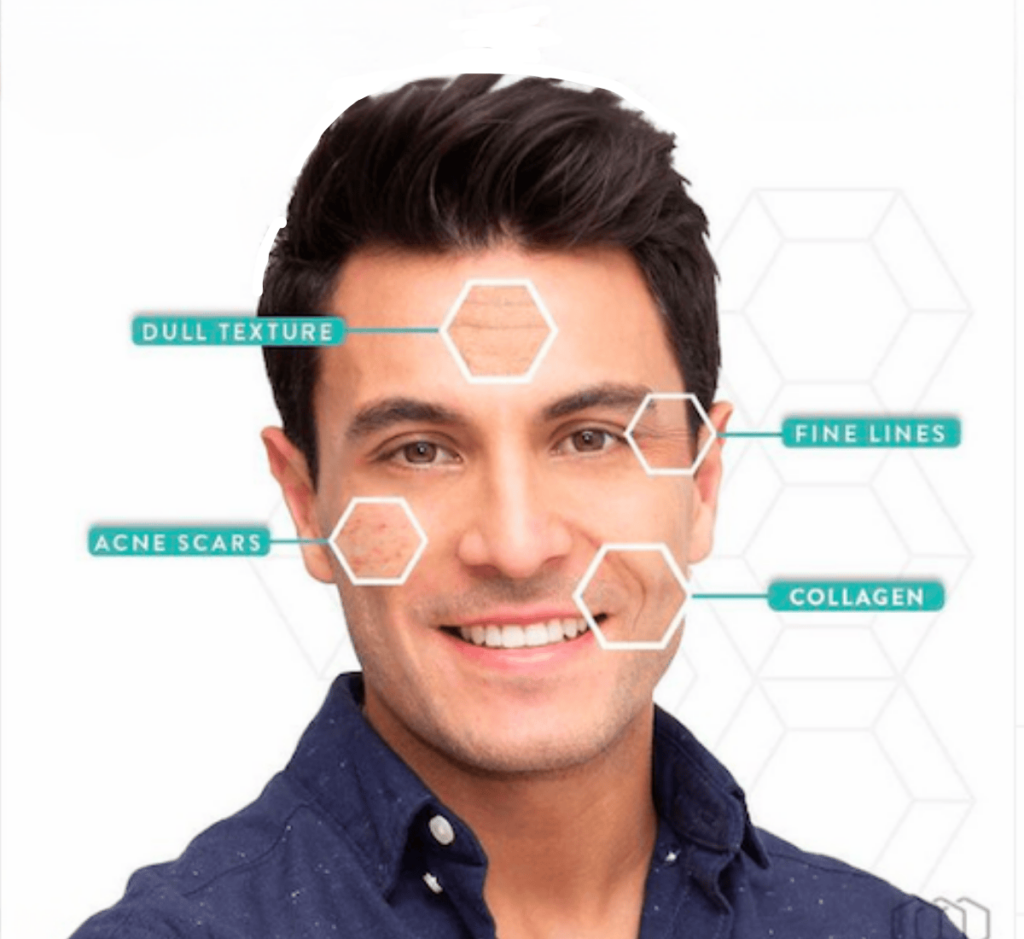 Microneedling for Men in Frisco | SCULPT Aesthetic Center