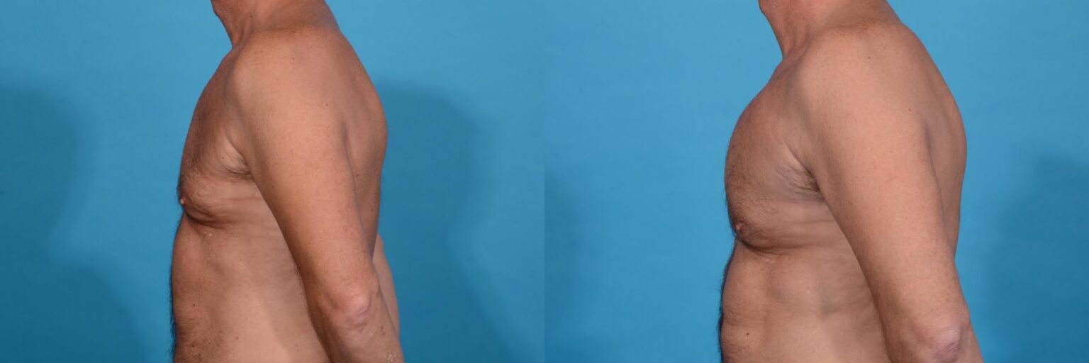 Male Pectoral Implants 3 | SCULPT Aesthetic Center