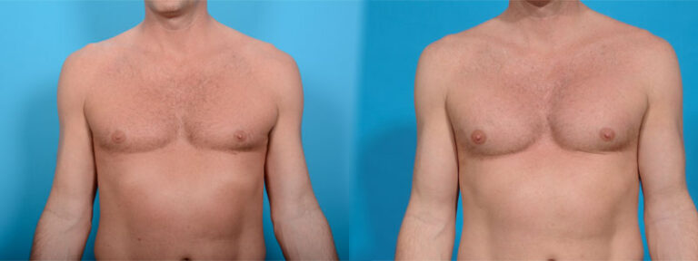 Male Pectoral Implants B&A 4 | SCULPT Aesthetic Center