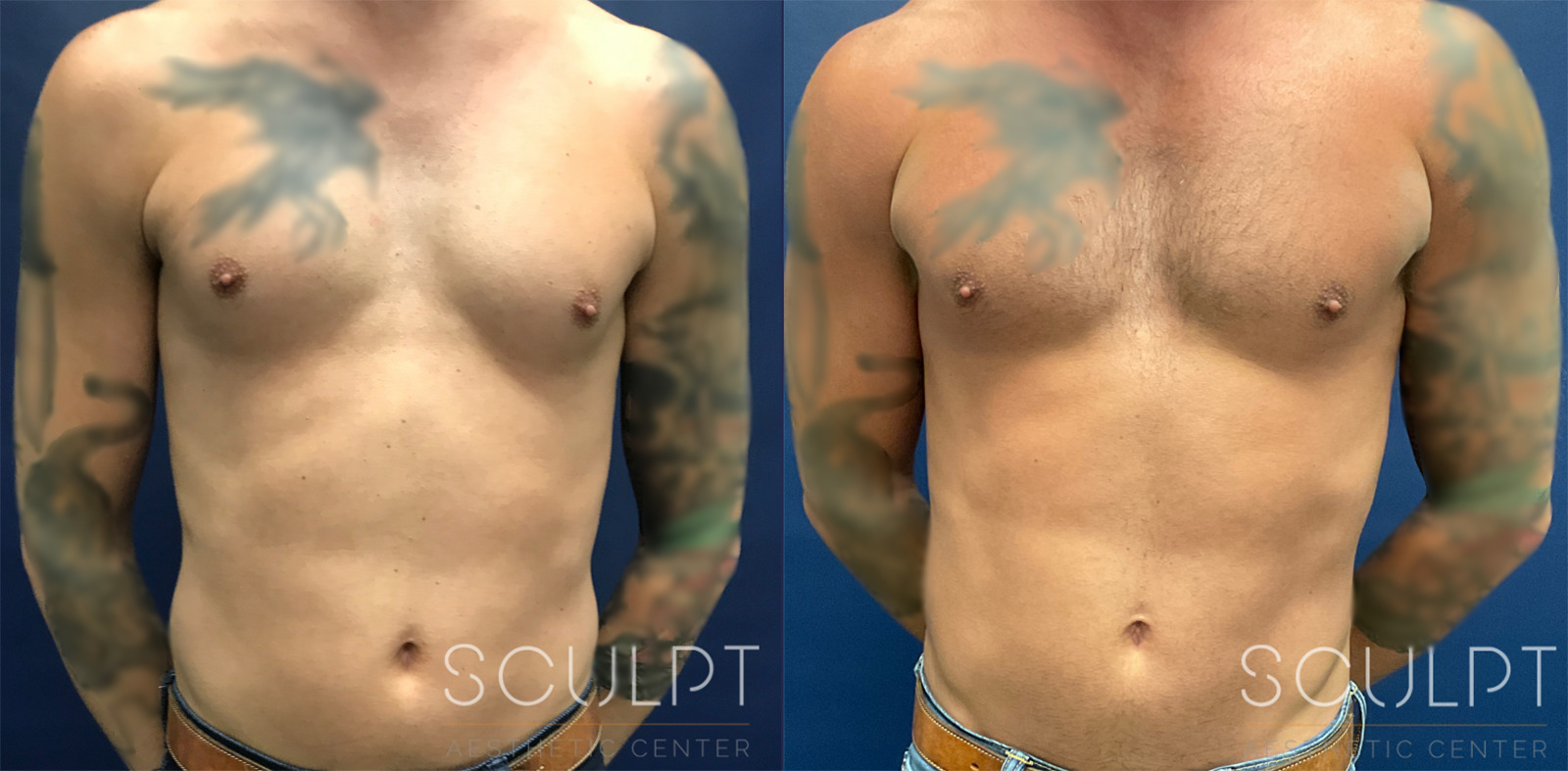 Male Pectoral Implants B&A 6 | SCULPT Aesthetic Center